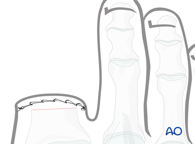 Amputation for Partial articular fractures of the proximal hallux
