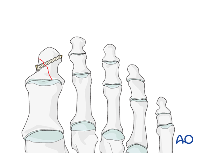 Lag-screw fixation for Distal hallux fractures