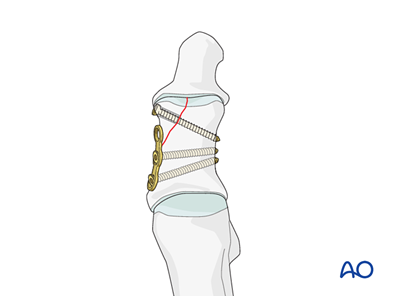 Lag-screw fixation for Partial articular fractures of the proximal hallux
