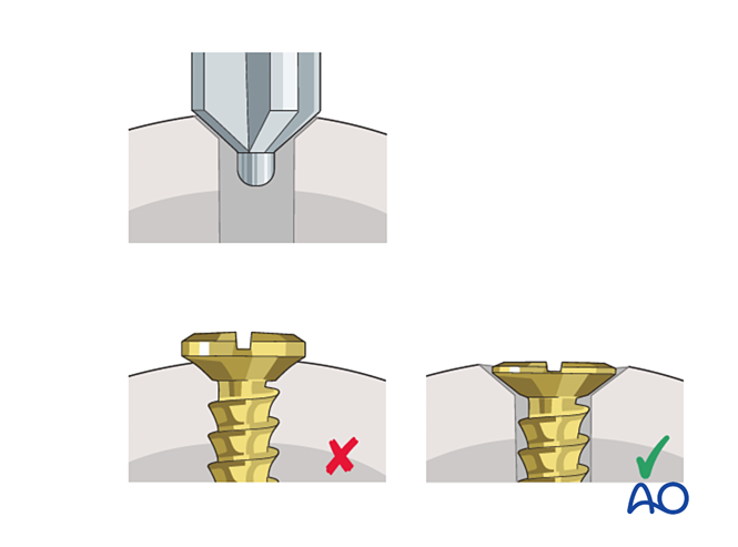 Lag screws with or without protection plate for Diaphyseal and ...