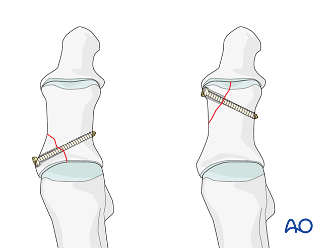 Lag-screw fixation for Partial articular fractures of the proximal hallux
