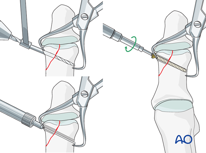 Lag-screw fixation for Partial articular fractures of the proximal hallux