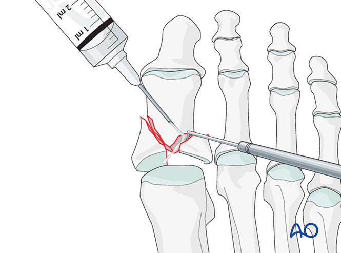 ORIF - Lag screws with or without plate for Complete articular ...