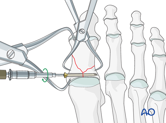 ORIF - Lag screws with or without plate for Complete articular ...