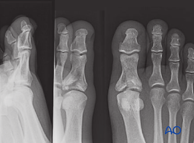 ORIF - Lag screws with or without plate for Complete articular ...