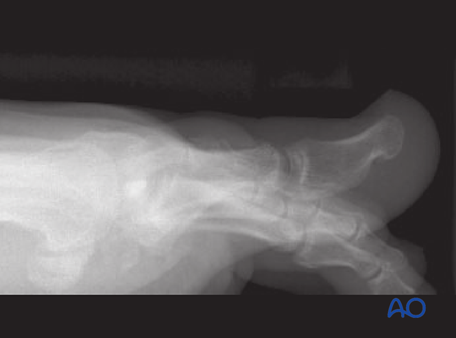 ORIF - Lag screws with or without plate for Complete articular ...