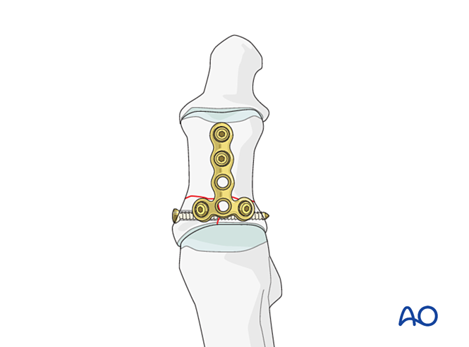 ORIF - Plate for Complete articular fractures of the proximal hallux