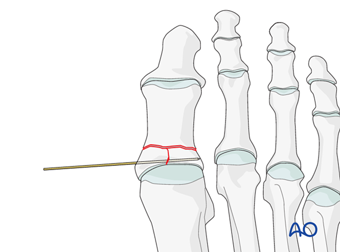 ORIF - Plate for Complete articular fractures of the proximal hallux