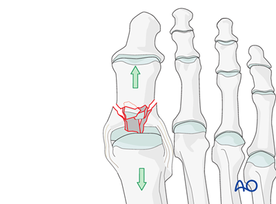 ORIF - Plate for Complete articular fractures of the proximal hallux