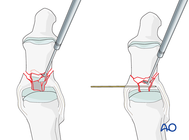 ORIF - Plate for Complete articular fractures of the proximal hallux