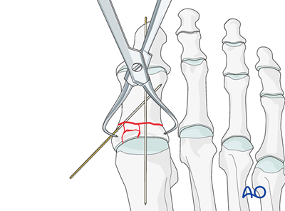 ORIF - Plate for Complete articular fractures of the proximal hallux