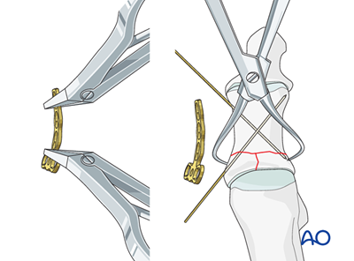 ORIF - Plate for Complete articular fractures of the proximal hallux