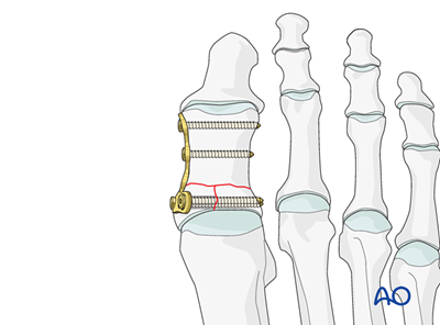 ORIF - Plate for Complete articular fractures of the proximal hallux