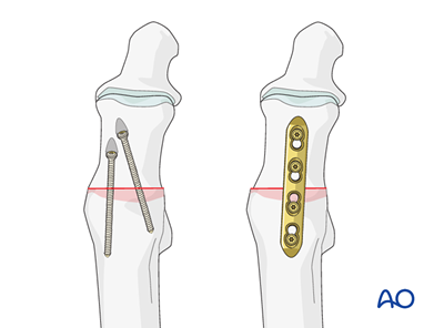 MTP joint fusion for Complete articular fractures of the proximal hallux