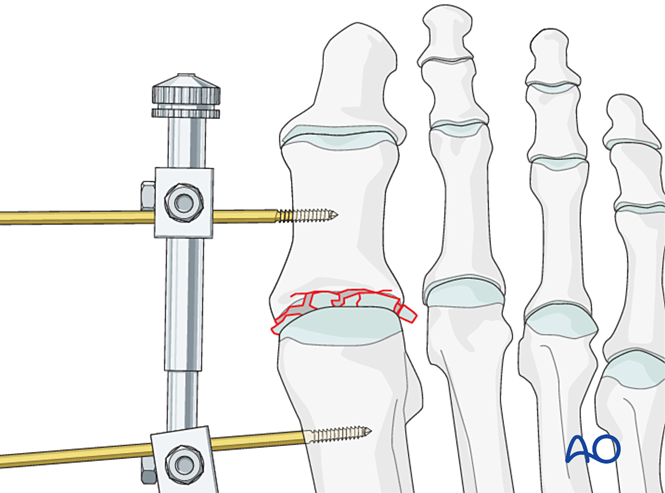 MTP joint fusion for Complete articular fractures of the proximal hallux