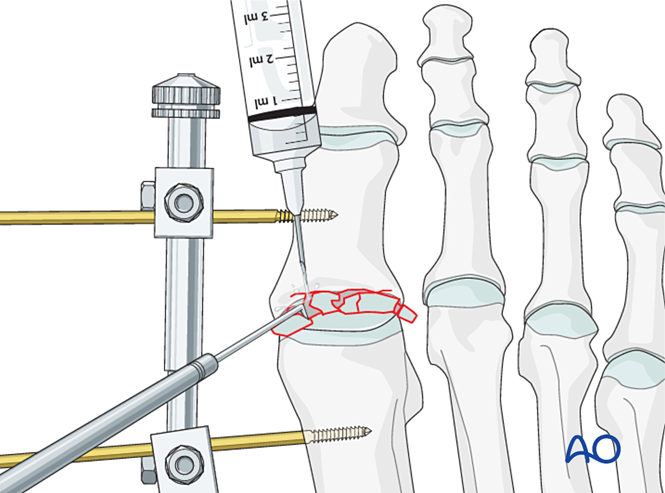 MTP joint fusion for Complete articular fractures of the proximal hallux