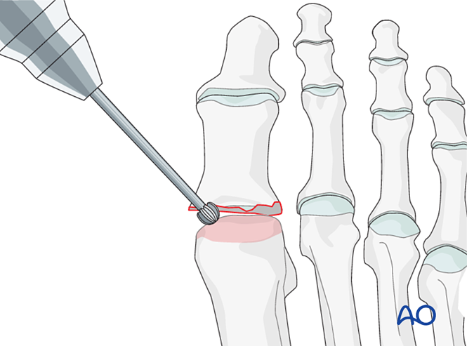 MTP joint fusion for Complete articular fractures of the proximal hallux