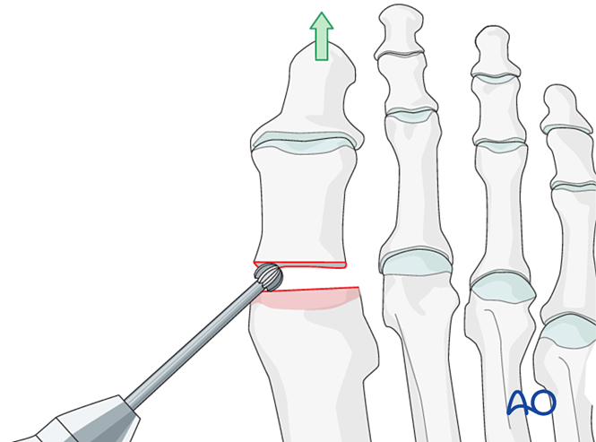 MTP joint fusion for Complete articular fractures of the proximal hallux