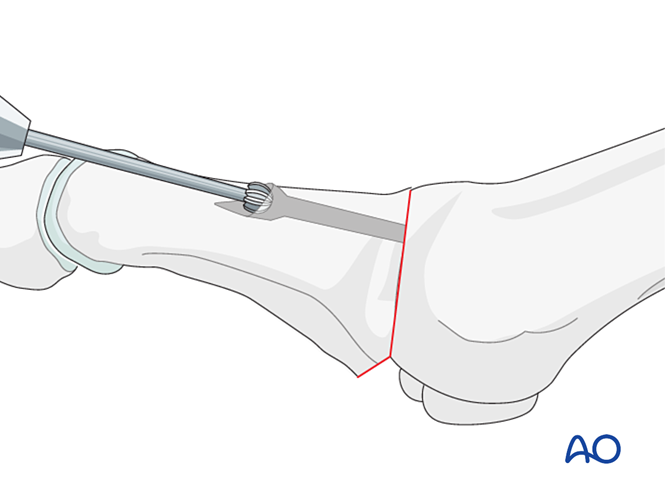 MTP joint fusion for Complete articular fractures of the proximal hallux