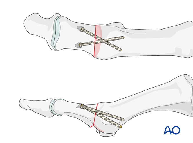 MTP joint fusion for Complete articular fractures of the proximal hallux