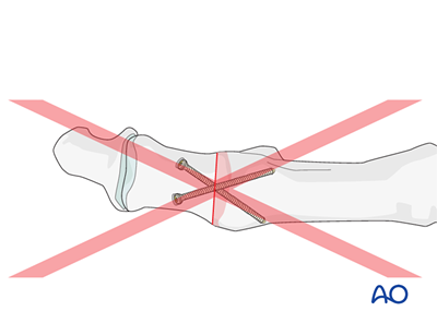 MTP joint fusion for Complete articular fractures of the proximal hallux