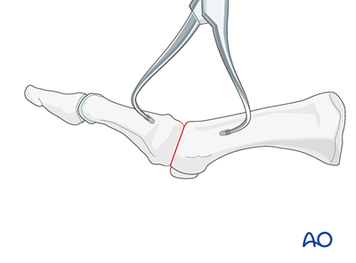 MTP joint fusion for Complete articular fractures of the proximal hallux
