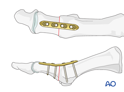 MTP joint fusion for Complete articular fractures of the proximal hallux