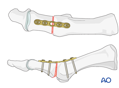 MTP joint fusion for Complete articular fractures of the proximal hallux