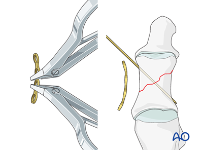 Lag screws with or without protection plate for Diaphyseal and ...