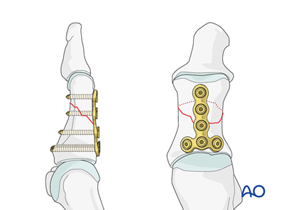 Plate fixation for Diaphyseal and extraarticular end segment fractures ...