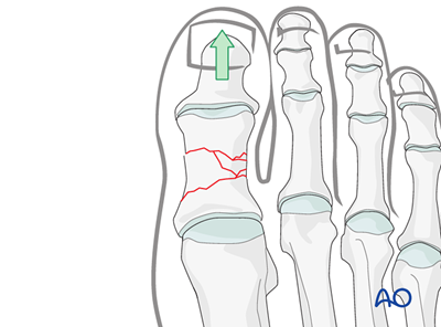 Plate fixation for Diaphyseal and extraarticular end segment fractures ...