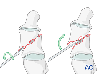 Plate fixation for Diaphyseal and extraarticular end segment fractures ...