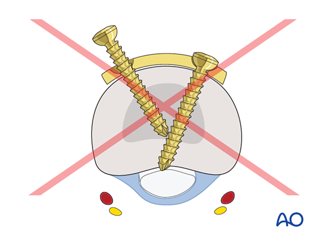 Plate fixation for Diaphyseal and extraarticular end segment fractures ...