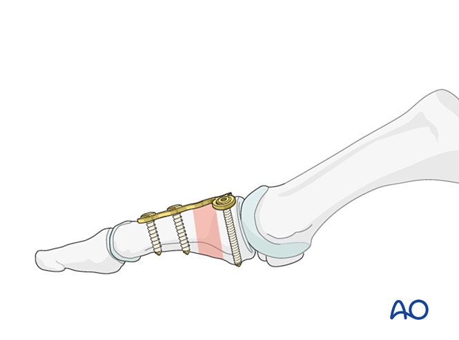 Plate fixation for Diaphyseal and extraarticular end segment fractures ...