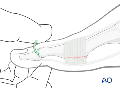Closed/open reduction with taping or rigid-soled shoe for MTP joint ...