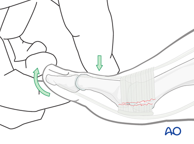CRIF - K-wire fixation for MTP joint dislocation
