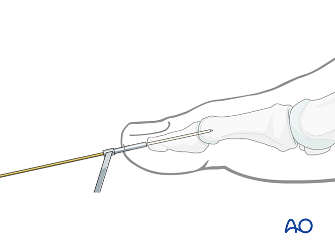 CRIF - K-wire fixation for MTP joint dislocation