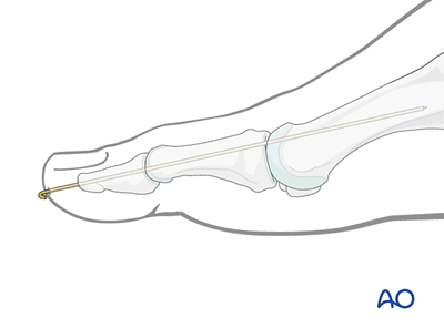 CRIF - K-wire fixation for MTP joint dislocation