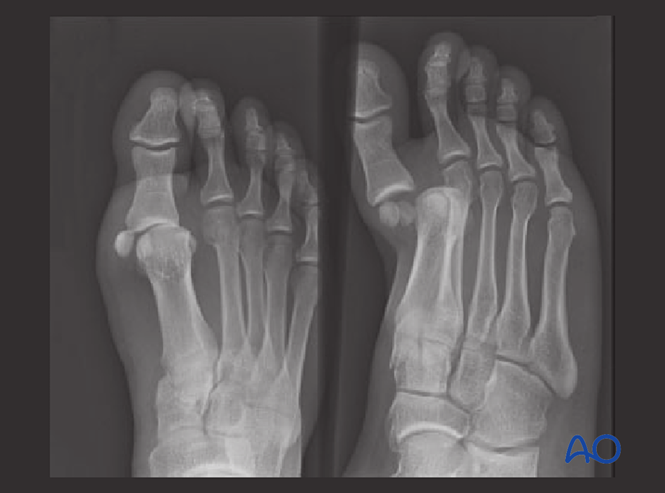 Closed/open reduction with taping or rigid-soled shoe for MTP joint ...