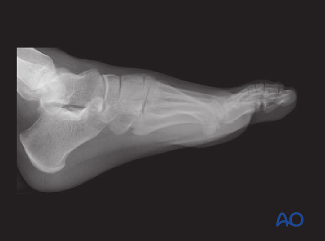 Closed/open reduction with taping or rigid-soled shoe for MTP joint ...