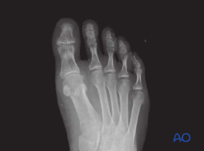 Closed/open reduction with taping or rigid-soled shoe for MTP joint ...