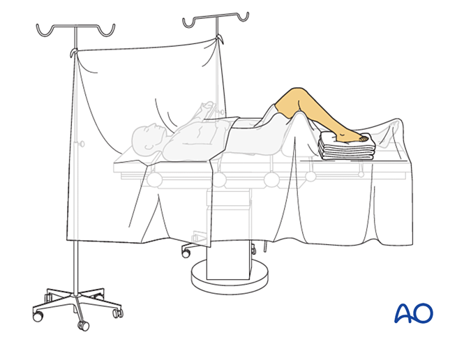 K-wire fixation for Diaphyseal and extraarticular end segment fractures ...
