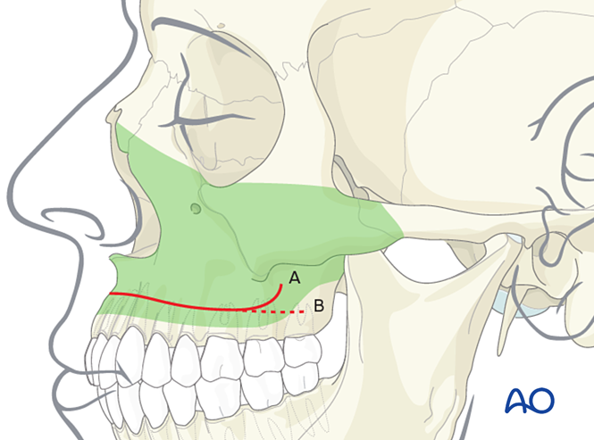 All approaches for the management of midface injuries