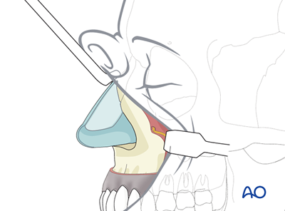 Approaches to the maxilla