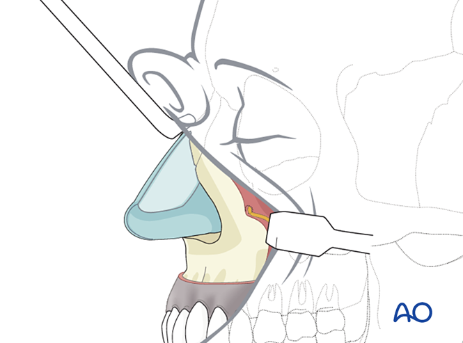 Approaches to the maxilla