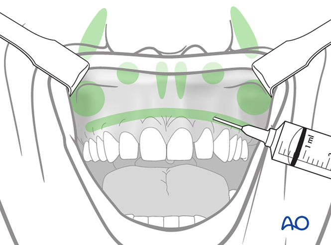 Maxillary vestibular approach