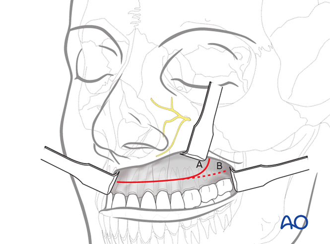 Maxillary vestibular approach