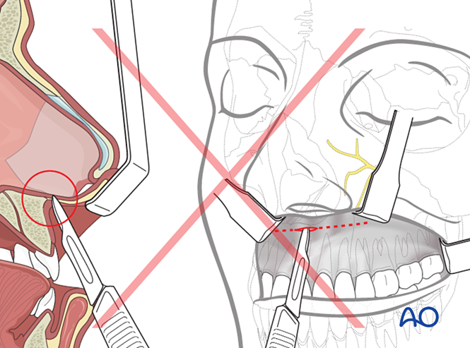 Maxillary vestibular approach