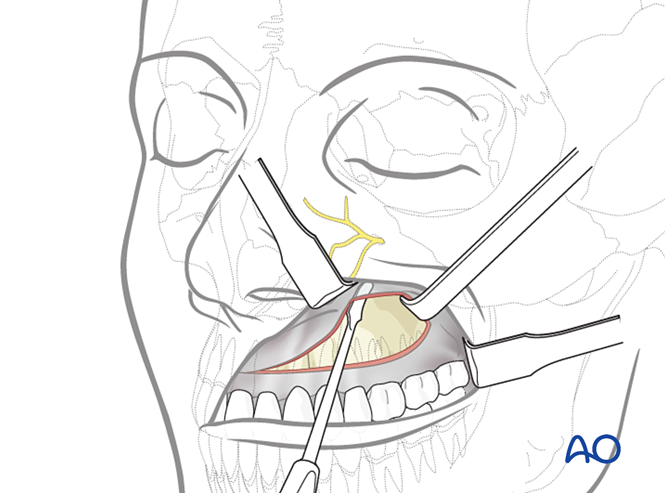 Maxillary vestibular approach