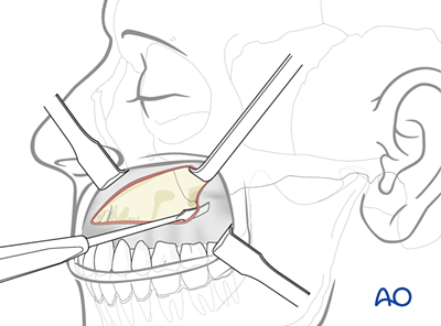 Maxillary vestibular approach